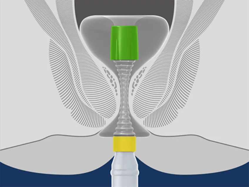 Advanced Medical Balloons brings Hygh-tec stool drainage system to the ...