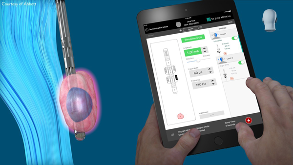 Abbott gets FDA nod for Infinity DBS in Parkinson’s disease, unveils ...