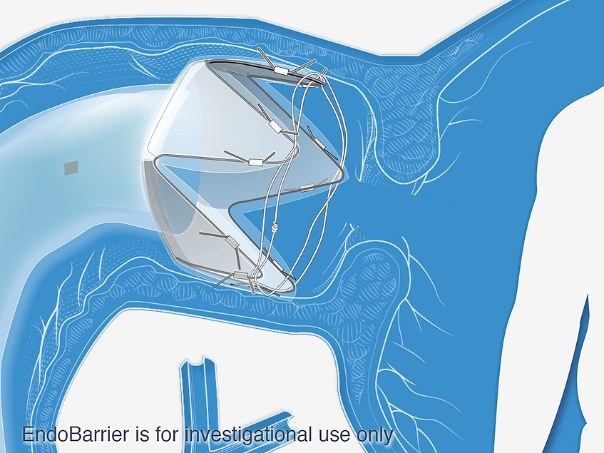 GI Dynamics enrolls first patient in pivotal Endobarrier trial | 2020 ...
