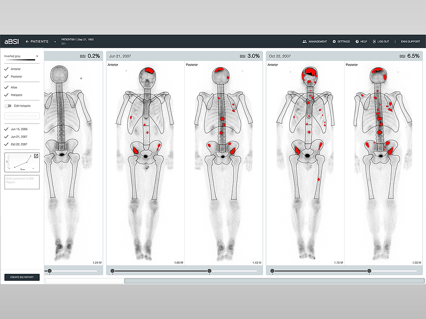 Lantheus receives clearance for AI-enabled bone scan run on GE ...