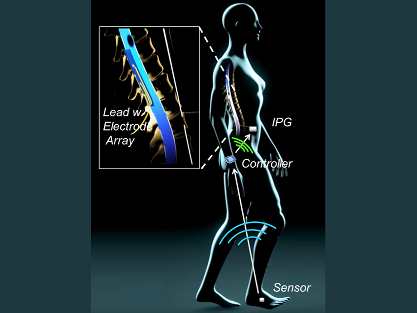 Gtx Medical receives breakthrough device designation for implanted ...
