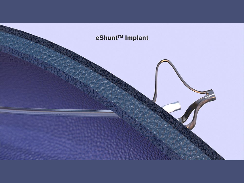 Cerevasc raises $43.9M to advance hydrocephalus treatment | 2020-06-09 ...