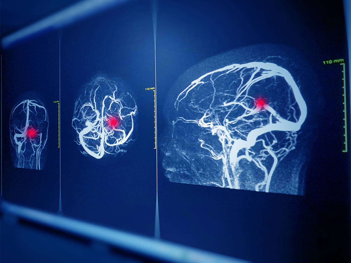 Medtronic expands roll out of radial artery access portfolio | 2021-02 ...