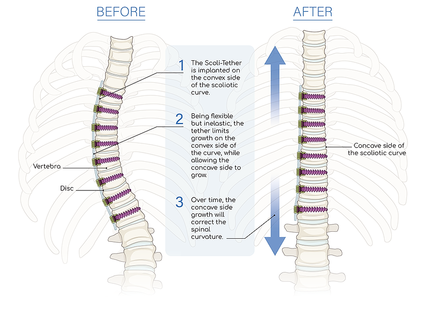 VBT device for treating adolescent scoliosis awarded breakthrough ...
