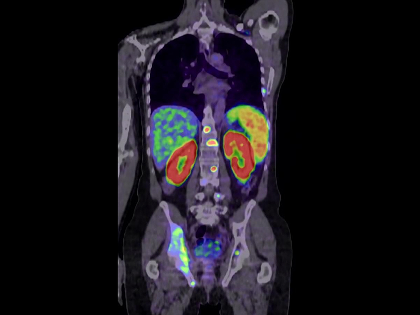 FDA approves Telix’s radiopharmaceutical prostate cancer imaging agent ...