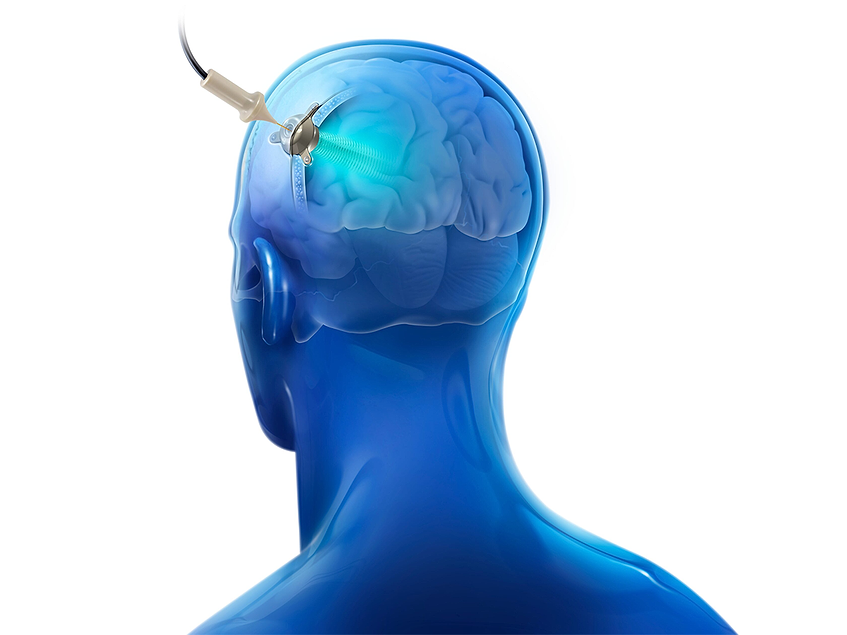 Carthera demonstrates potential of Sonocloud for lowering amyloid load ...