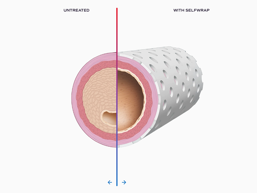 Venostent’s Selfwrap wins breakthrough device designation | BioWorld
