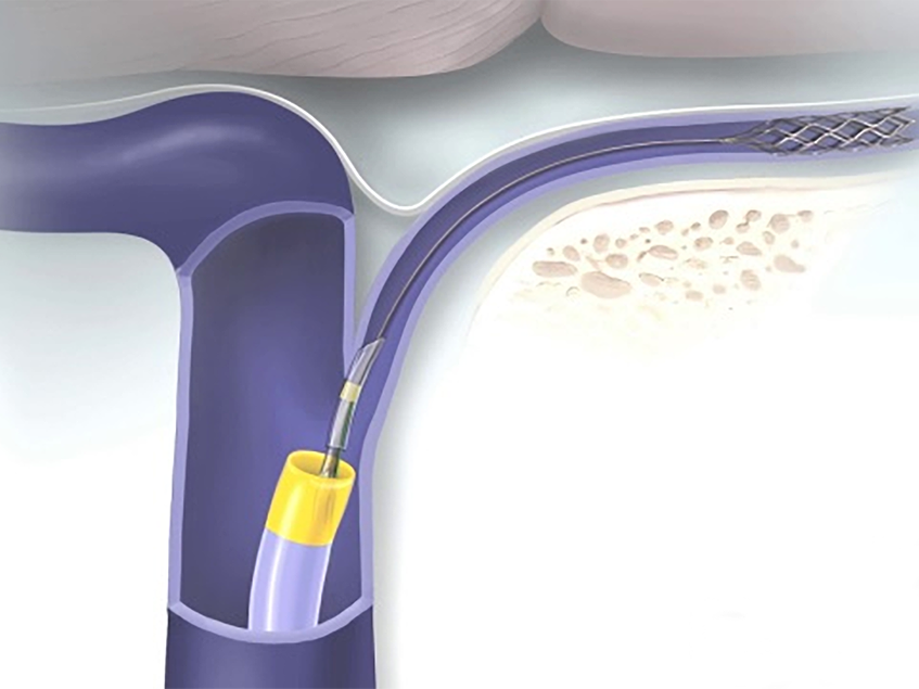 First US patient receives Eshunt for treatment of hydrocephalus | BioWorld