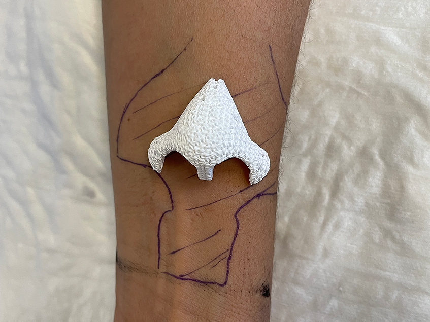 Surgeons reconstruct patient’s nose using entirely 3D-printed ceramic ...