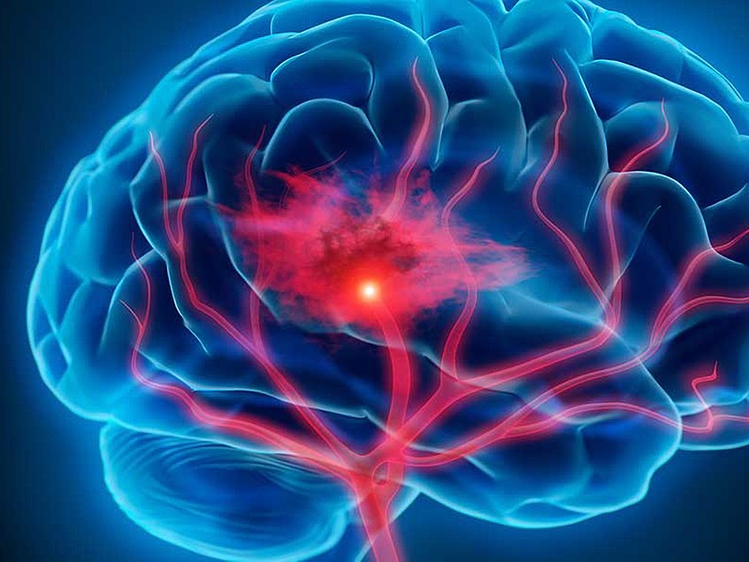 Booster consortium works on new bioactive stentriever for ischemic ...