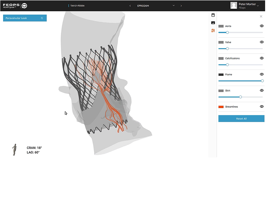 Feops looks to raise €10m, its Heartguide shown to significantly ...