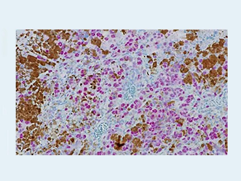 Roche’s anti-PRAME antibody launched in China for melanoma diagnosis ...