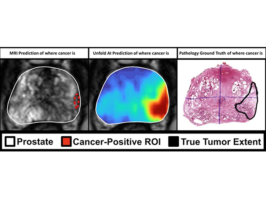 Avenda Health’s AI-powered prostate cancer mapping tool outperforms ...