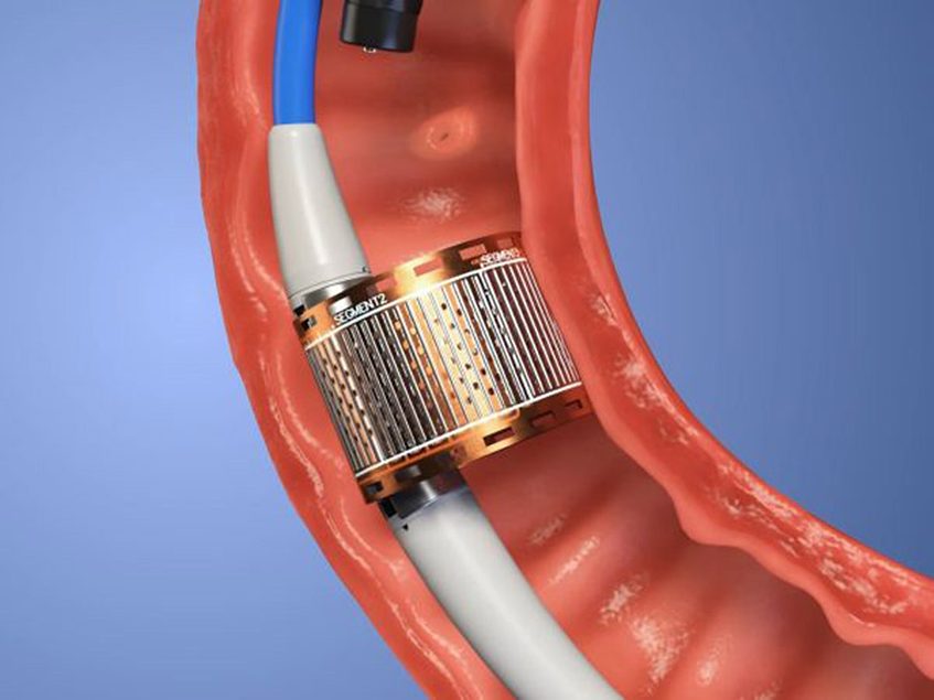 Treatment with Endogenex device eliminates the need for insulin in type ...