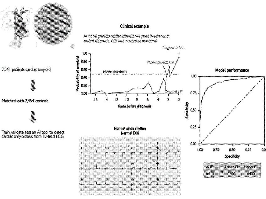Mayo Clinic researcher develops AI-based test for cardiac amyloidosis ...