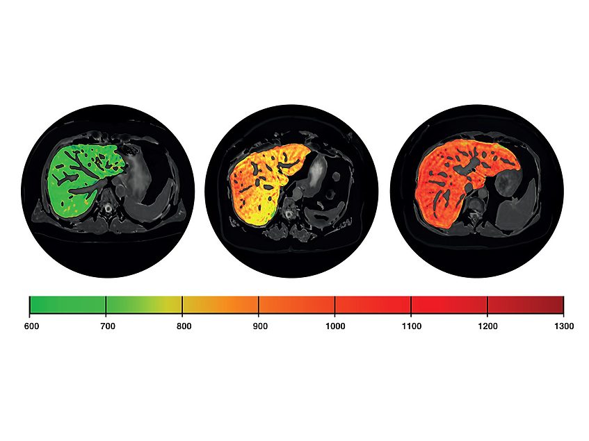 Early liver disease detection can help prevent heart problems | BioWorld