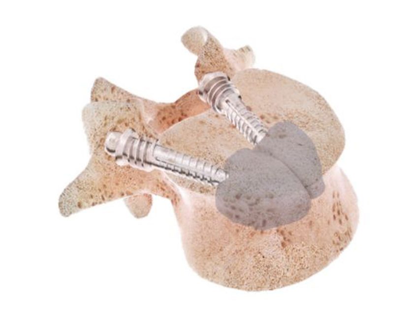 Safe Orthopaedics unveils promising device for vertebral compression ...