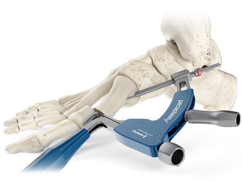 Novastep acquisition puts Enovis on firm footing | BioWorld