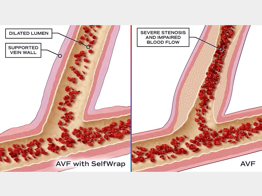 Venostent rounds up $16M round to study bioabsorbable wraps for ...