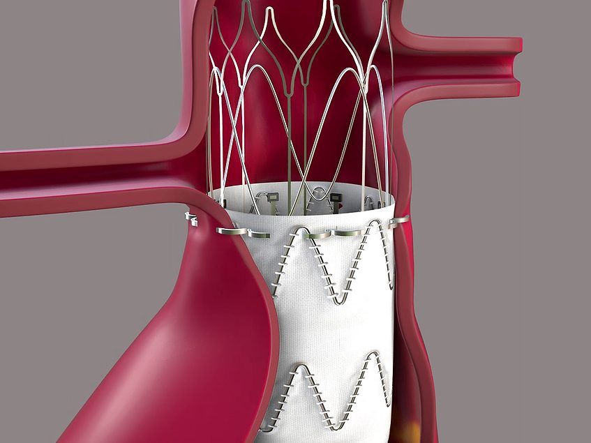 Endoron raises $10M for Aortoseal AAA repair device | BioWorld