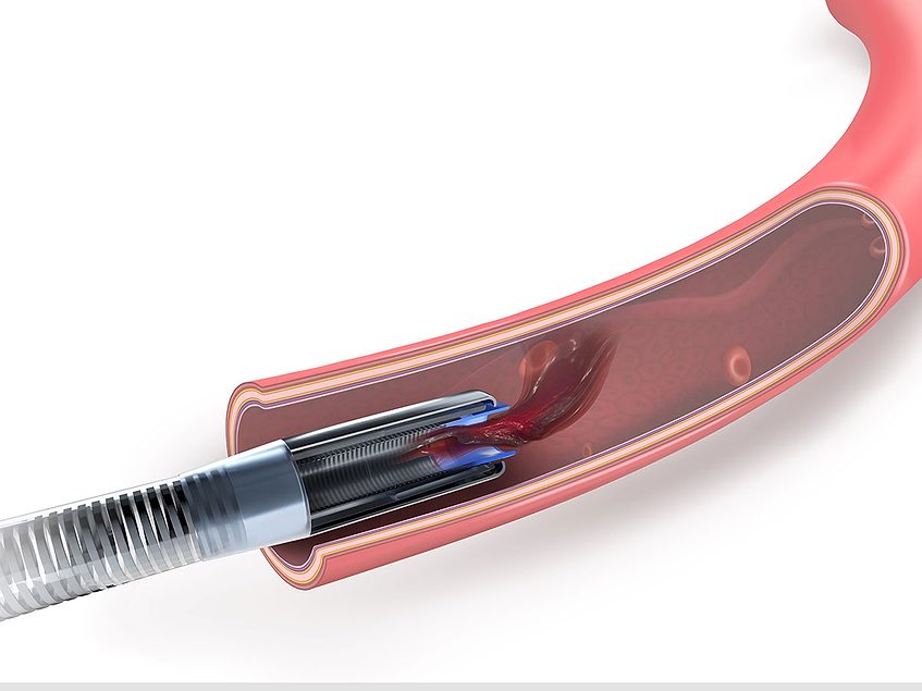 FDA clears Expanse Ice system for small vessel aspiration | BioWorld