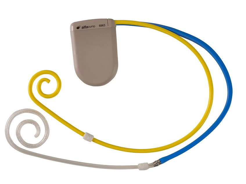 Sequana gets FDA nod for Alfapump to treat patients with ascites | BioWorld