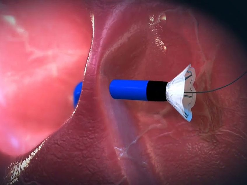 J&J pumps up cardiac commitment with $1.7B V-Wave acquisition | BioWorld