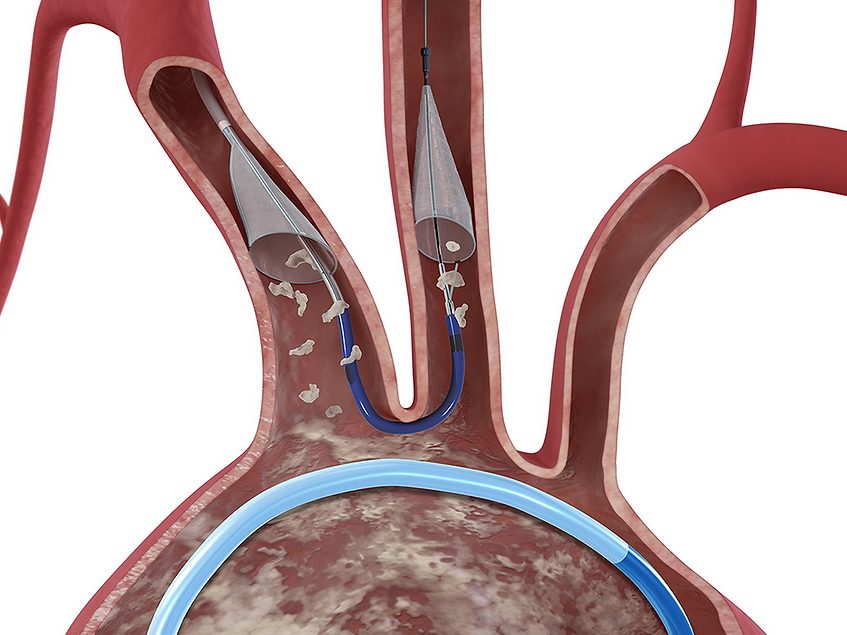 No benefit found for cerebral protection device in TAVR | BioWorld