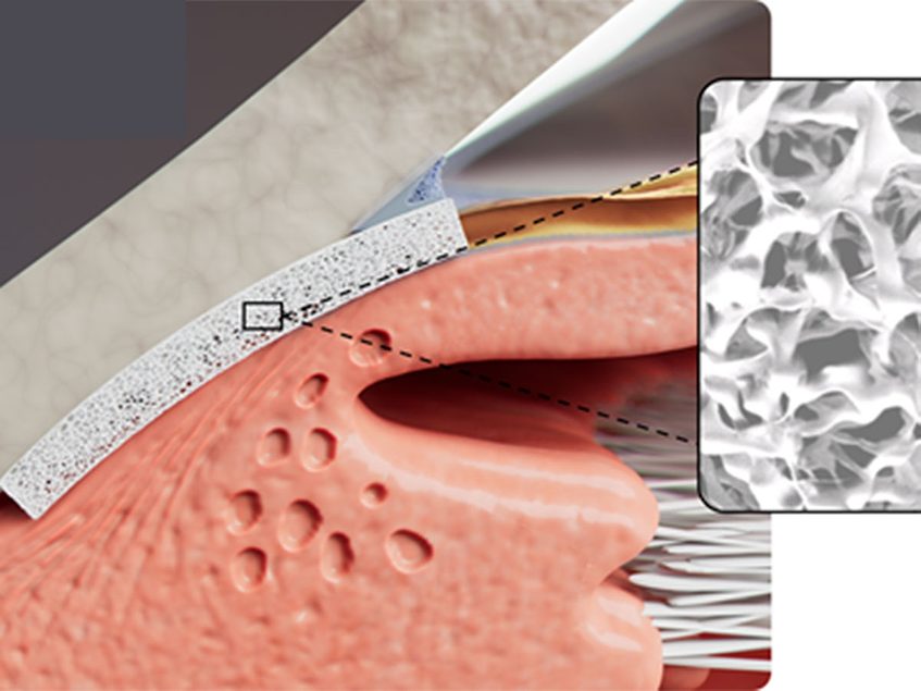 Iantrek raises $42M for Alloflo Uveo glaucoma therapy launch | BioWorld