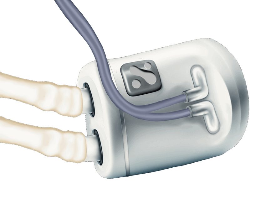 Nephrodite's Holly renal replacement named breakthrough device | BioWorld