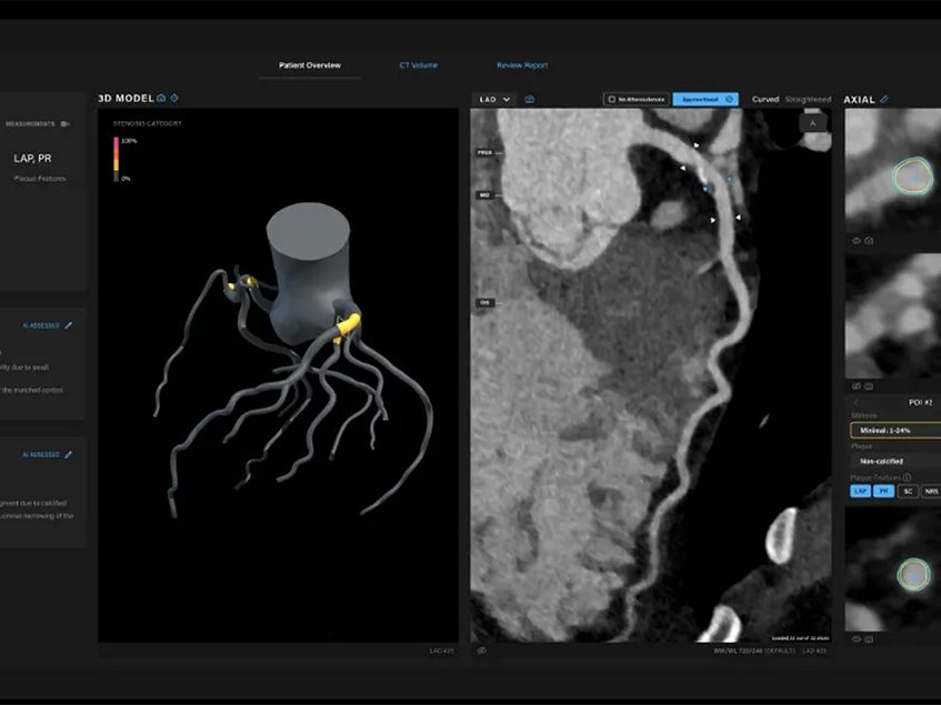 FDA clears Artrya’s AI-based coronary anatomy software | BioWorld