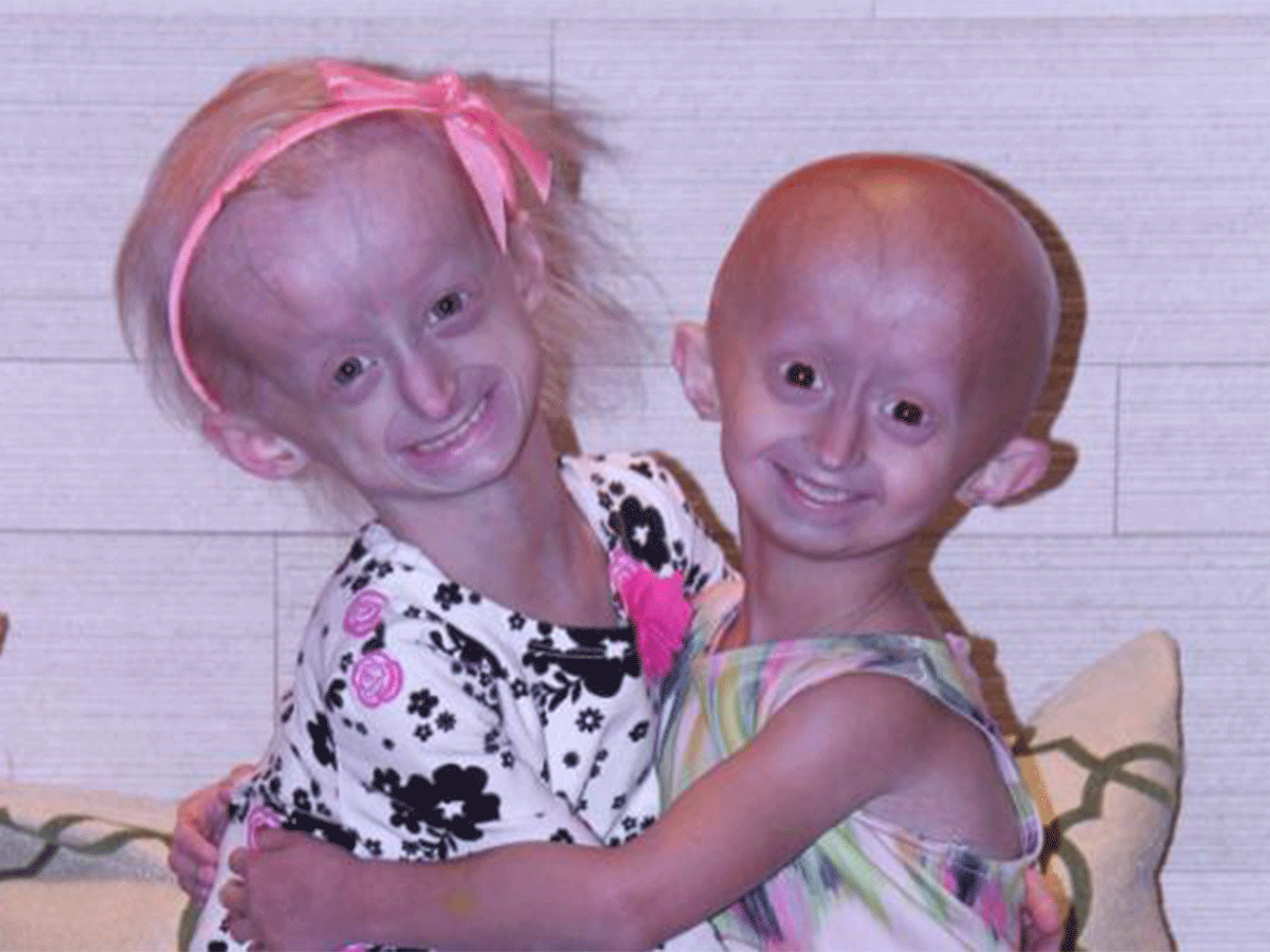 Progeria Treatment Trials