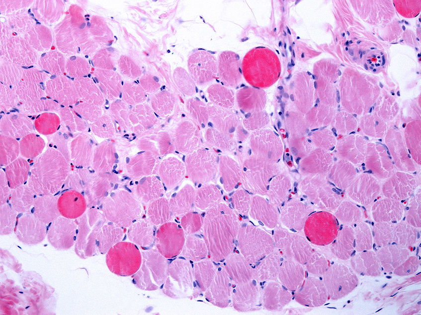 EPI-321 gene therapy leads phenotypic rescue in humanized murine model ...