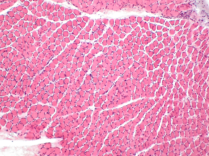 Inmune Bio uses DN-TNF biologic to target soluble TNF to increase ...