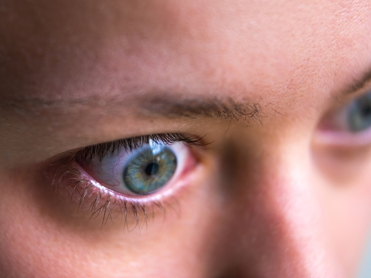 Exophthalmos Bulging Eyes Due To Thyroid Disease Stock 2+ Hundred