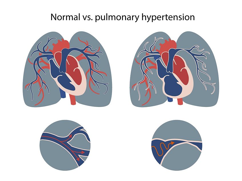 Effect of COR-1389 on cardiopulmonary function in pulmonary ...