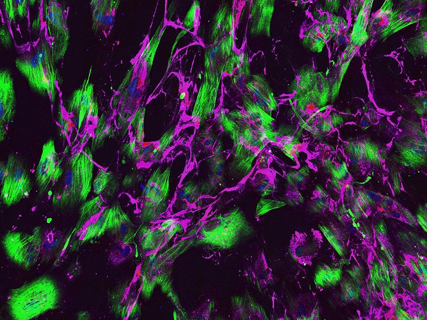 Novel iPSC-derived cell model of human COL4A1/A2 small vessel disease ...