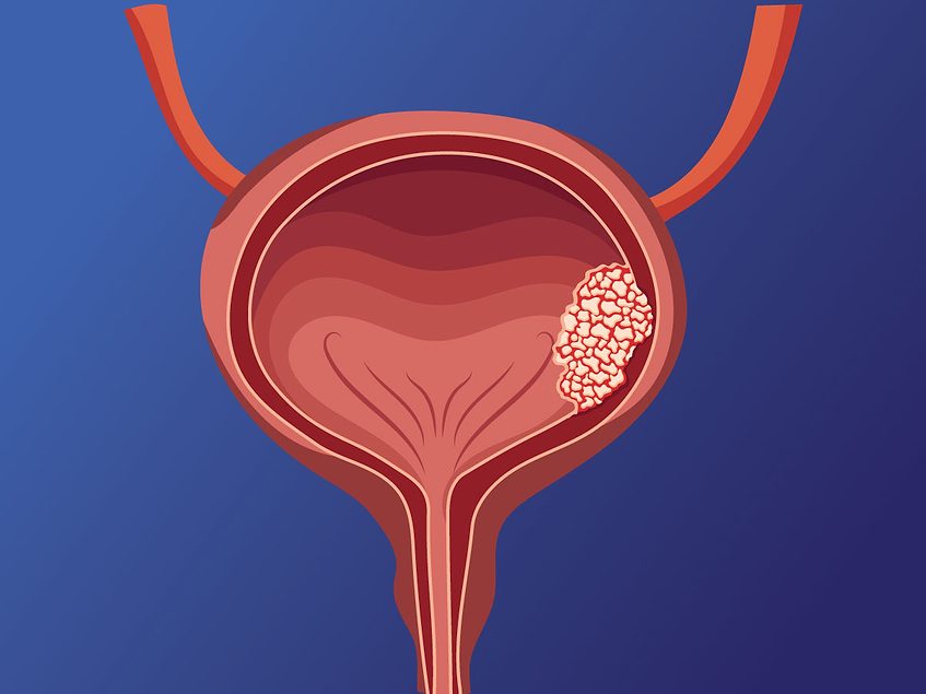 Minze, Medtronic partner on overactive bladder care in EMEA | BioWorld