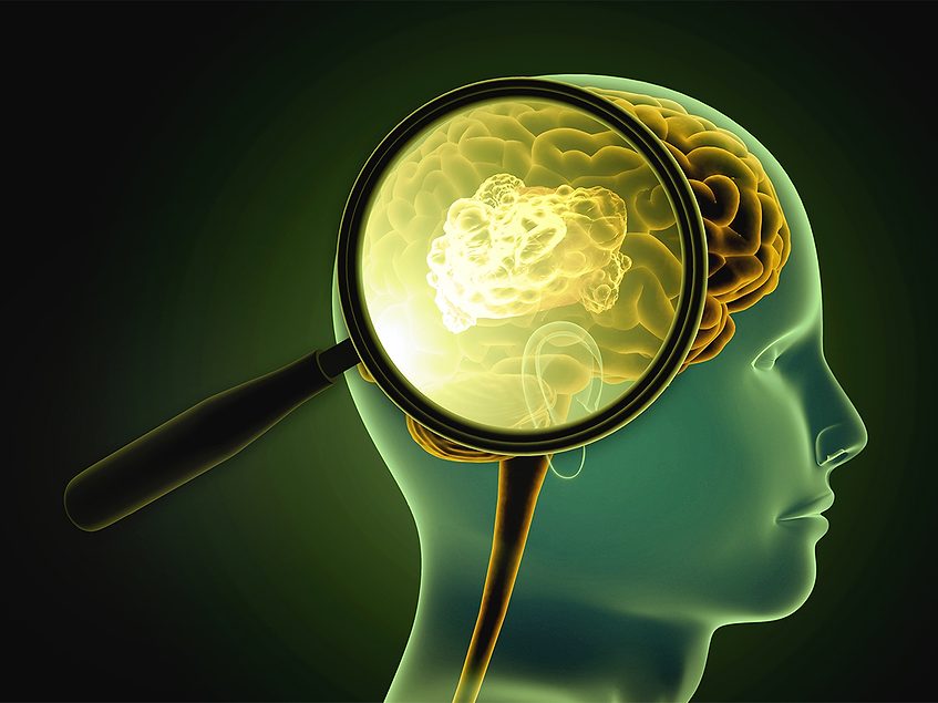 Researchers discover how glioblastoma tumors dodge chemotherapy | BioWorld
