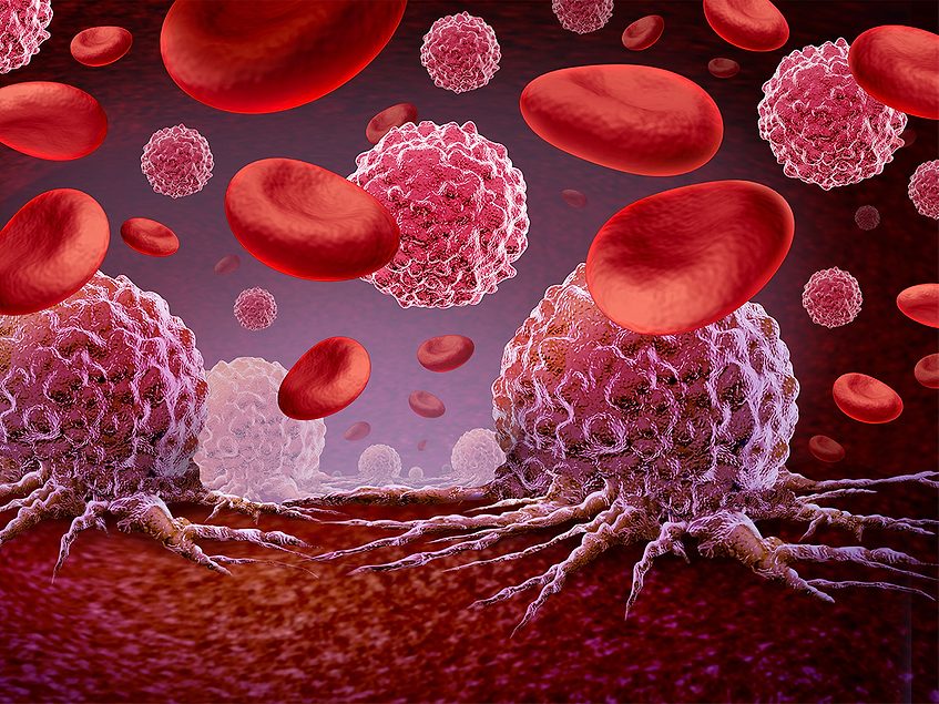 CCRL2 is therapeutic target in acute erythroid leukemia | BioWorld