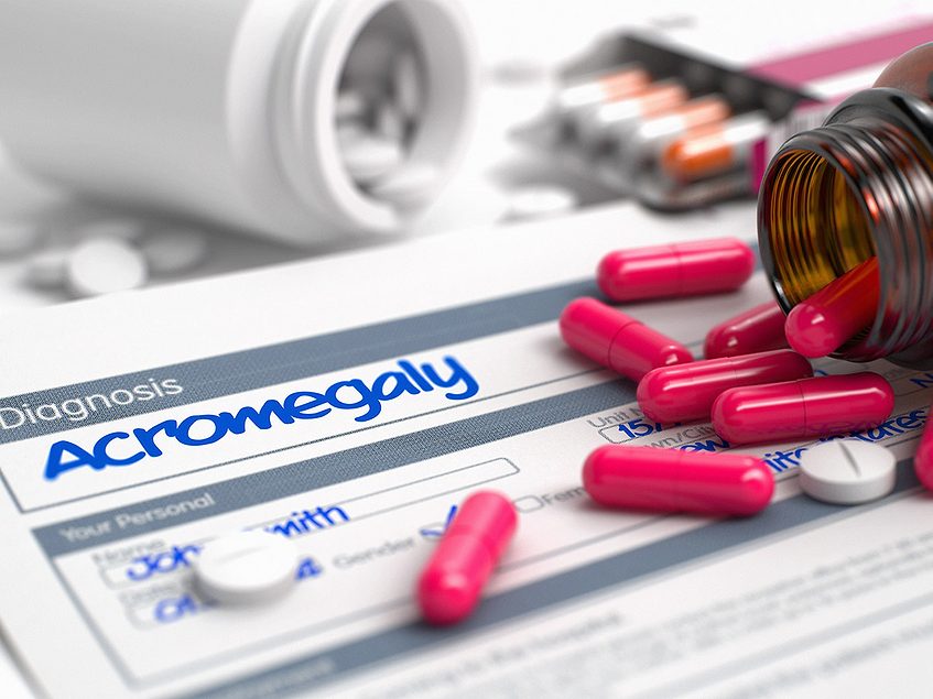 No critics for Crinetics as paltusotine pill aces acromegaly endpoints ...