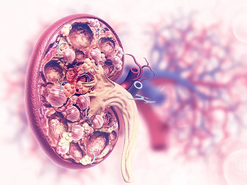 Renasant Bio launches to develop disease-modifying treatments for ADPKD ...