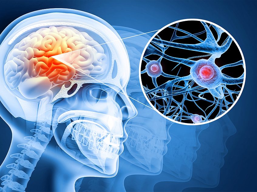 Neuronal damage promotes tumor proliferation and drug resistance | BioWorld