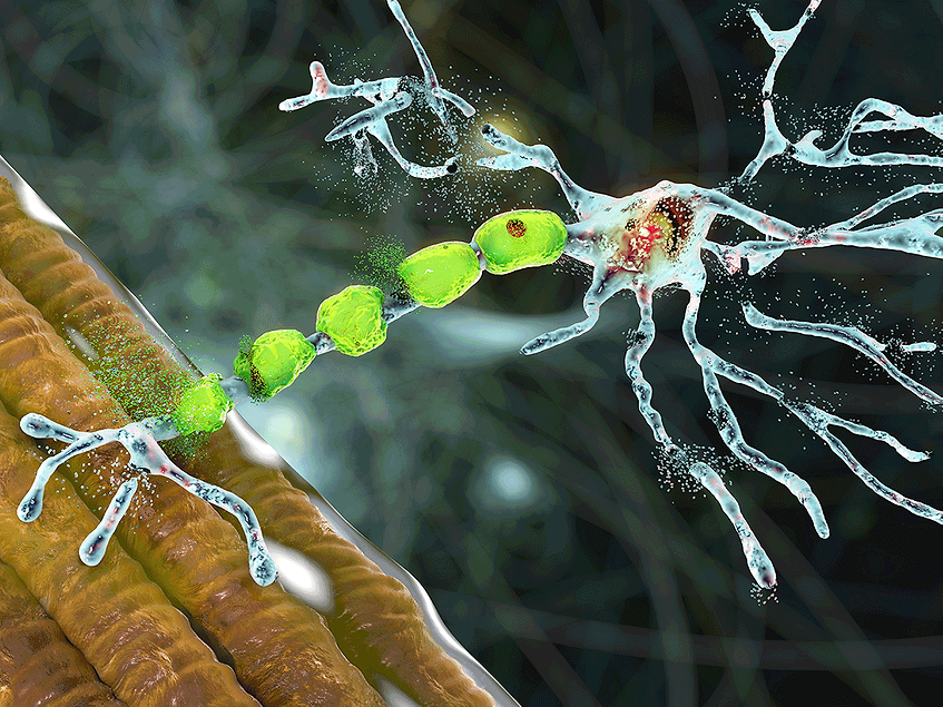 Next-generation gene therapy shows superior efficacy for spinal ...