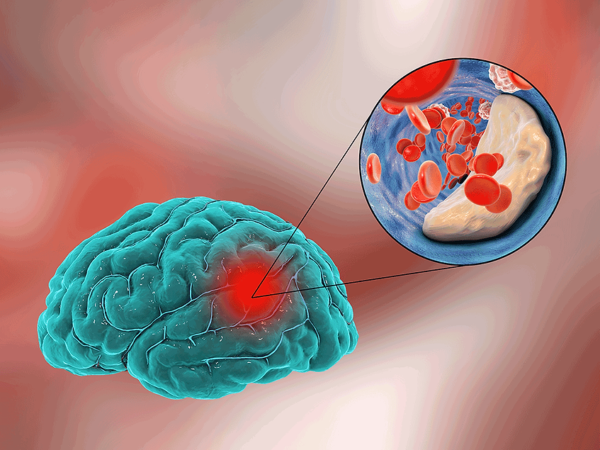 Fast-acting and reversible: Basking seeks to expand options in ischemic ...